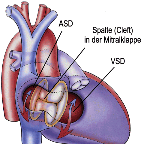Atrioventrikulärer Septumdefekt (AVSD)