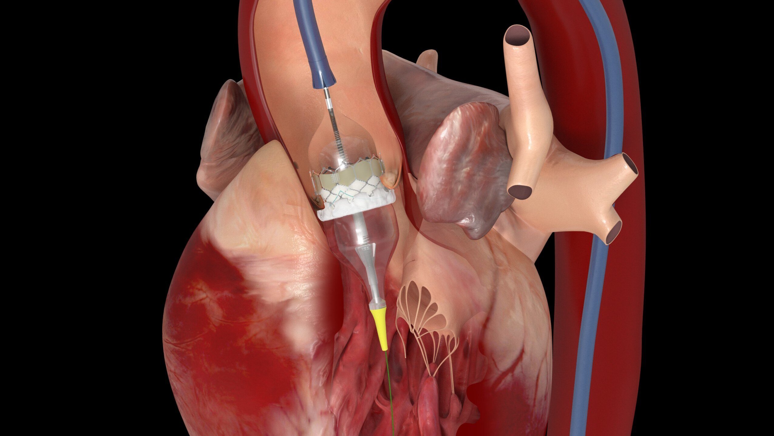 TAVI • Transkatheter-Aortenklappenimplantation - Deutsches Herzzentrum der Charité