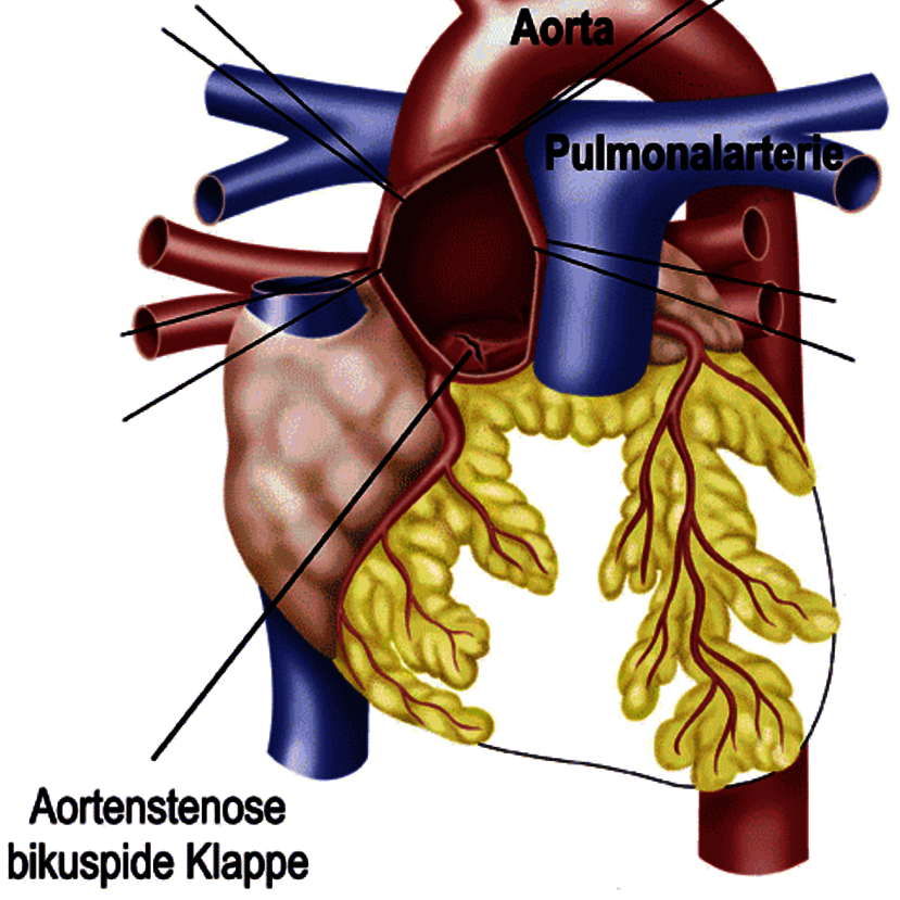 Die Aorta • Funktion, Erkrankungen und Behandlungen - Deutsches ...
